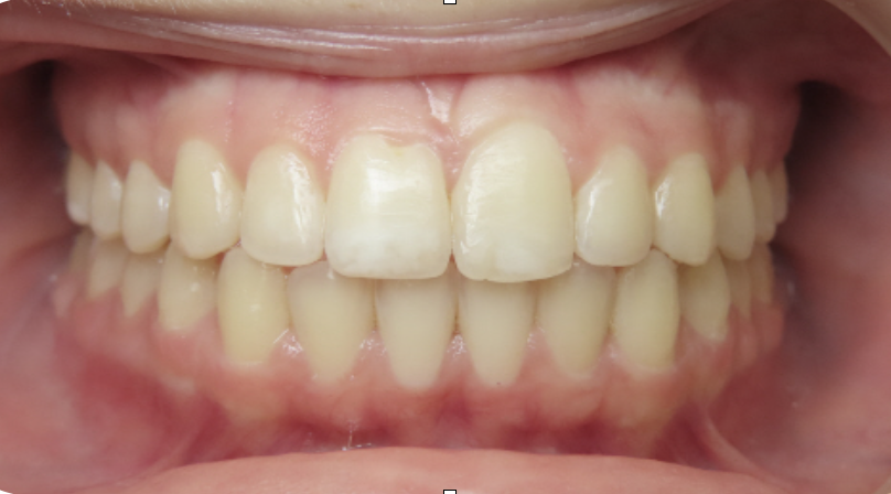 Braces - Buena Vista Orthodontics