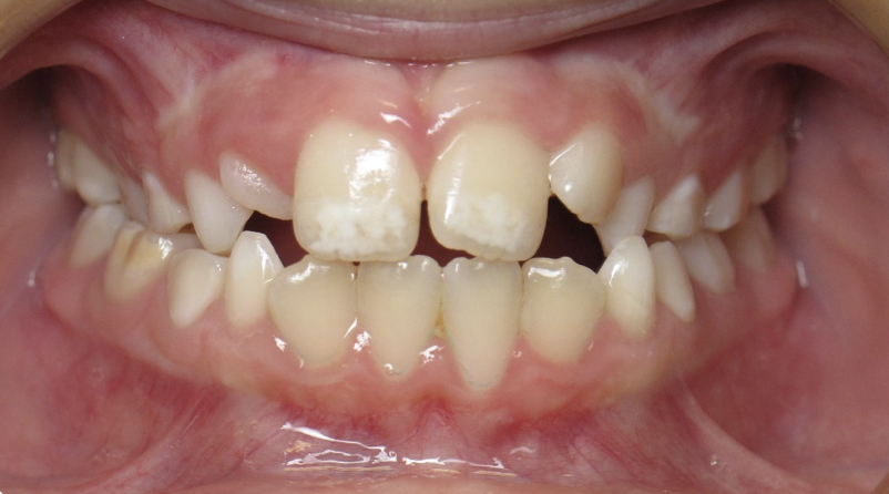 Braces - Buena Vista Orthodontics