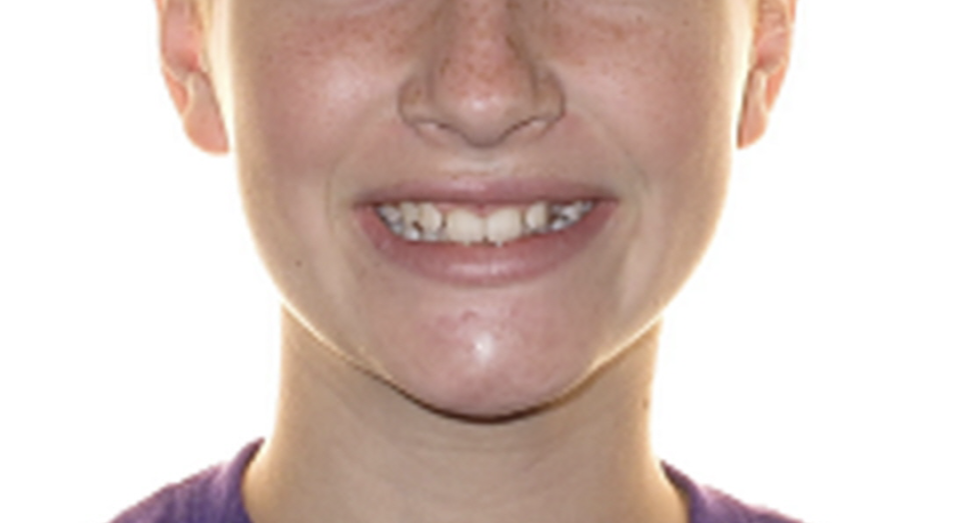 Braces - Buena Vista Orthodontics